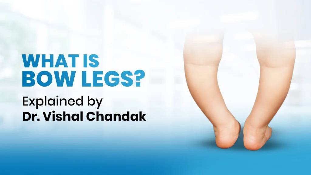 what is bow legs| Explained by Dr. Vishal Chandak